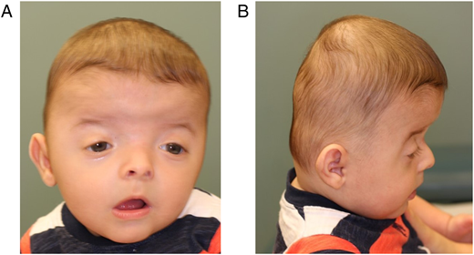 Identifying the Misshapen Head: Craniosynostosis and Related Disorders ...