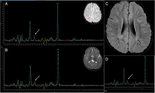Creatine Transporter Deficiency Presenting as Autism Spectrum Disorder ...
