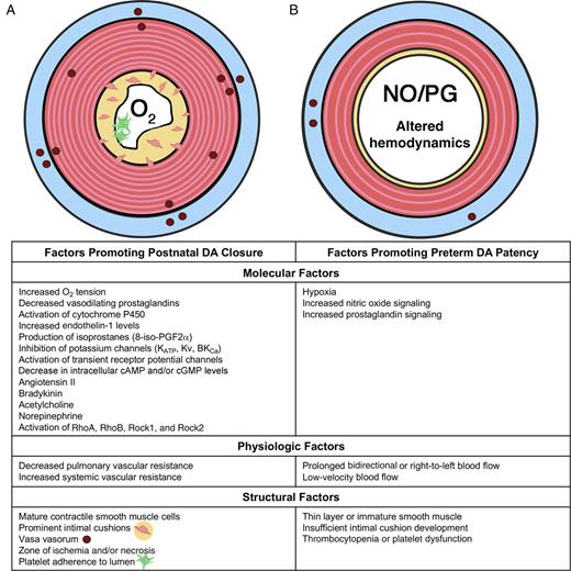 Patent Ductus Arteriosus of the Preterm Infant | Pediatrics | American ...