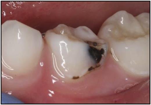 Fluoride Use in Caries Prevention in the Primary Care Setting ...