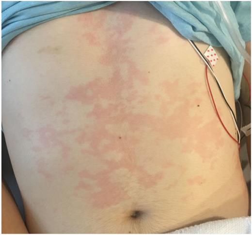 A Gut Feeling: Abdominal Symptoms as an Initial Presentation of EVALI ...