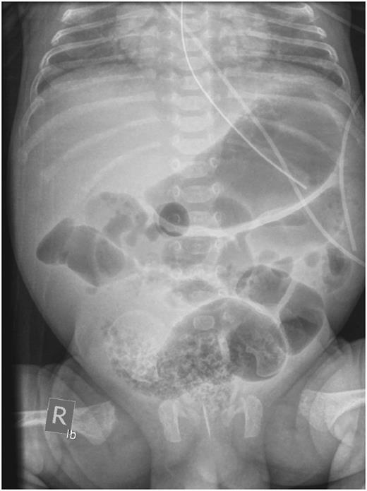 Necrotizing Enterocolitis in Neonates With Hyperinsulinemic ...