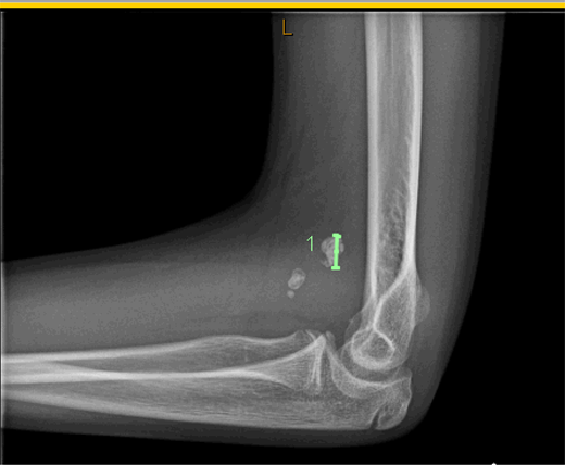 A Unique Cause of Elbow Pain And Loss Of Range Of Motion In A 13-Year ...