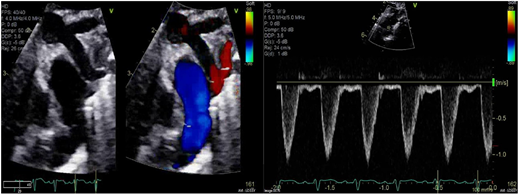 Diastolic Right-To-Left Shunting PDA In Neonatal Coarctation Is A Sign ...