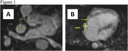 Smaller Fontan Pathway is Associated with Fontan Failure | Pediatrics ...