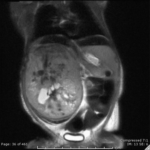 The Baby with a Big Belly: Life-threatening Abdominal Distention in a ...
