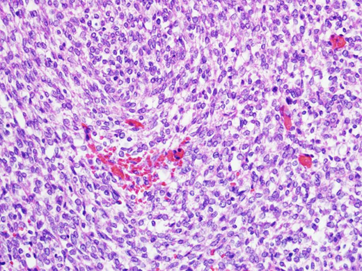 The Baby with a Big Belly: Life-threatening Abdominal Distention in a ...