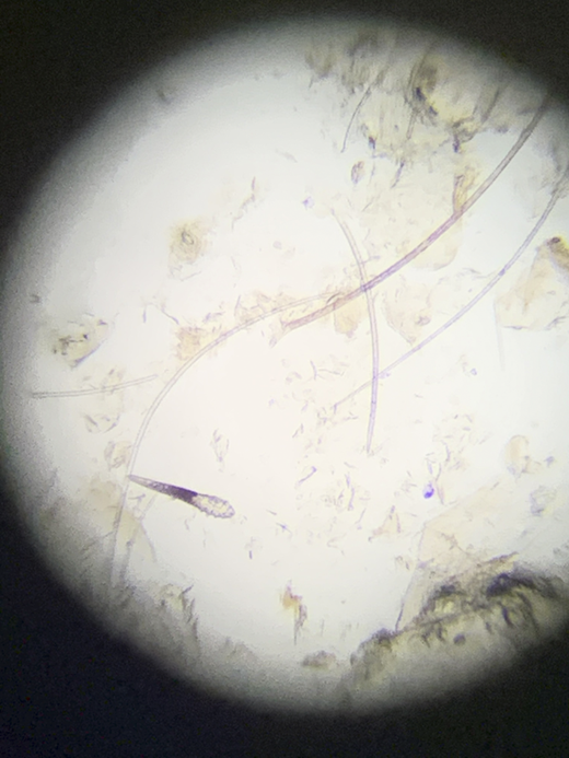 Demodex Folliculitis and Recent Dupilumab Administration | Pediatrics ...