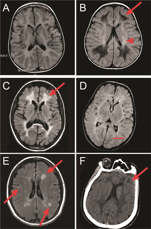 Leukodystrophies in Children: Diagnosis, Care, and Treatment ...