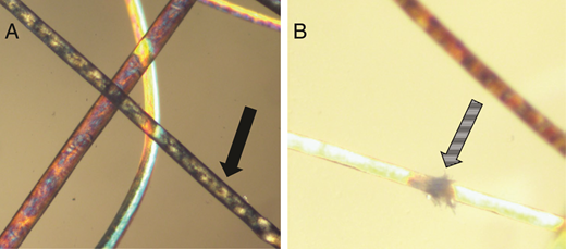 Metronidazole-Induced Hepatitis in a Teenager With Xeroderma ...