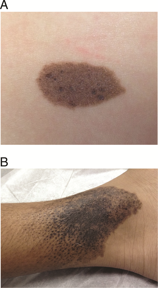 Care of Congenital Melanocytic Nevi in Newborns and Infants: Review and ...