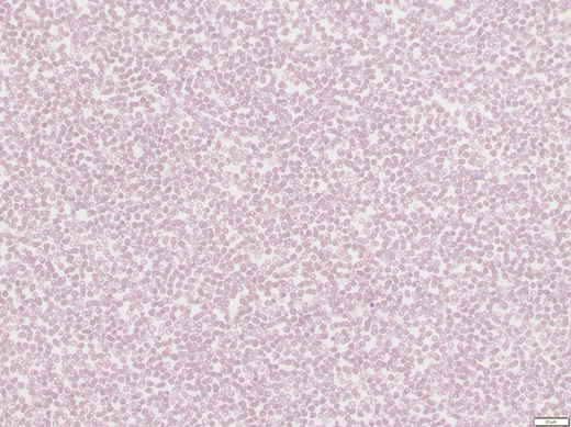 Reticular Dysgenesis: A Rare Immunodeficiency in a Neonate With ...