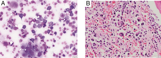 Reticular Dysgenesis: A Rare Immunodeficiency in a Neonate With ...
