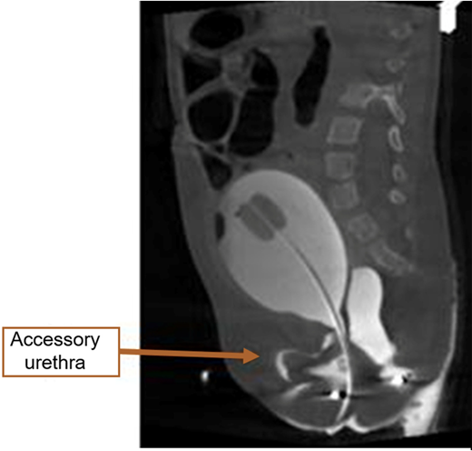 Where Is the Vagina? A Rectal Stricture After a Presumed Cloacal Repair ...