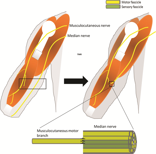 Challenges and Potential in Targeted Muscle Reinnervation in Pediatric ...