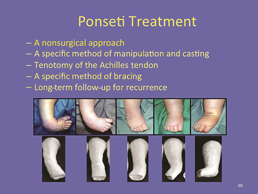 Diagnosis and Treatment of Idiopathic Congenital Clubfoot | Pediatrics ...