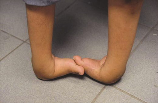 Diagnosis and Treatment of Idiopathic Congenital Clubfoot | Pediatrics ...