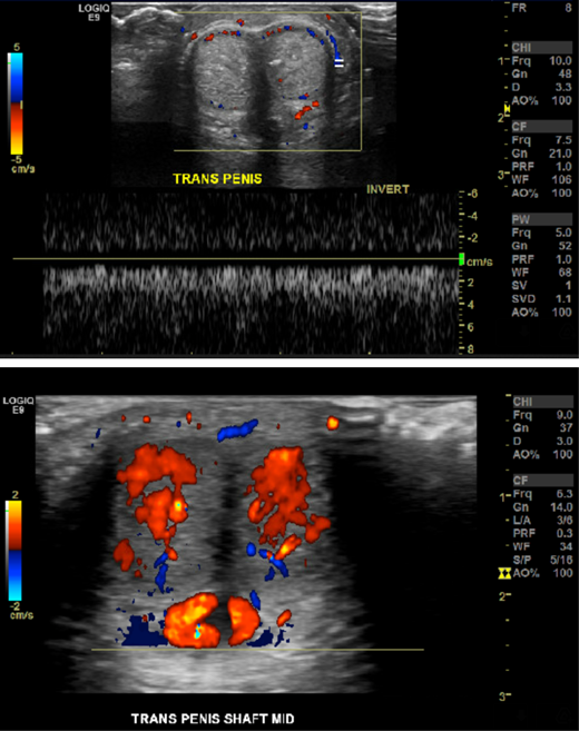 Acute Management of Prolonged, Recalcitrant Priapism in a Pediatric ...