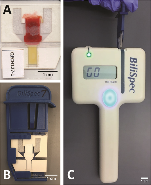 Evaluation of a Point-of-Care Test for Bilirubin in Malawi | Pediatrics ...