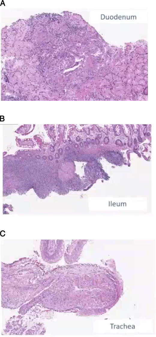 A 7-Year-Old With Persistent Fever and Cough | Pediatrics | American ...