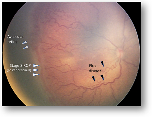 Retinopathy of Prematurity: A Global Perspective and Recent ...