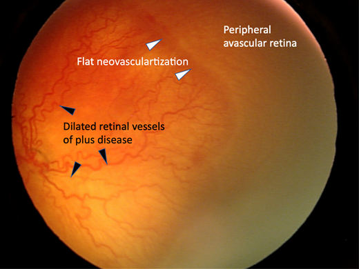 Retinopathy of Prematurity: A Global Perspective and Recent ...