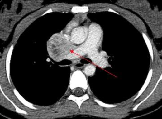 A 14-Year-Old Female With Chest Mass, Shortness of Breath, and ...
