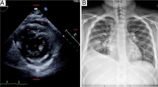 Recurrent Rash in an 11-Year-Old Boy With Pericardial and Pleural ...