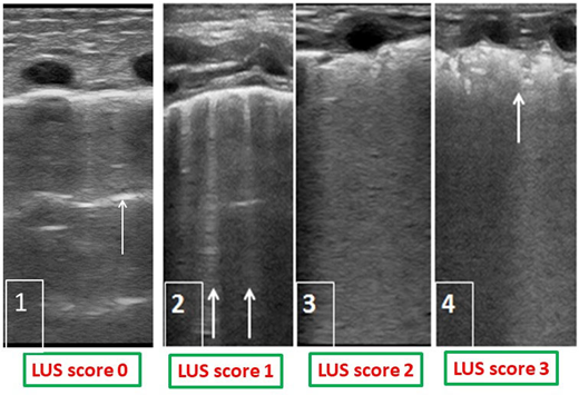 Use of Point-of-Care Ultrasonography in the NICU for Diagnostic and ...
