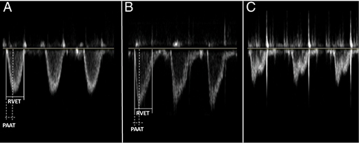 Targeted Neonatal Echocardiography in Patients With Hemodynamic ...