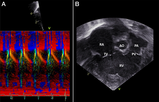 Targeted Neonatal Echocardiography in Patients With Hemodynamic ...
