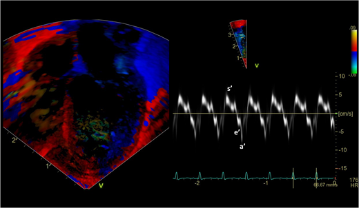 Targeted Neonatal Echocardiography in Patients With Hemodynamic ...