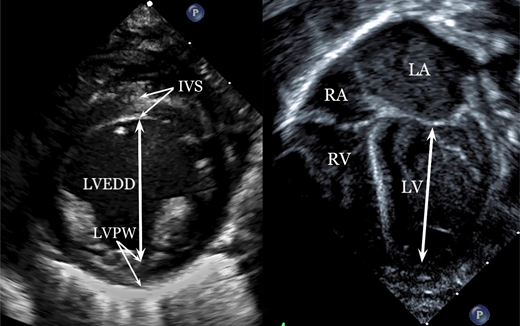 Targeted Neonatal Echocardiography in Patients With Hemodynamic ...