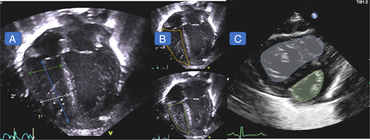 Targeted Neonatal Echocardiography in Patients With Hemodynamic ...