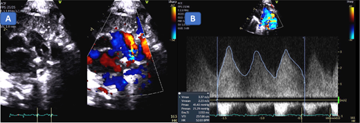 Targeted Neonatal Echocardiography in Patients With Hemodynamic ...