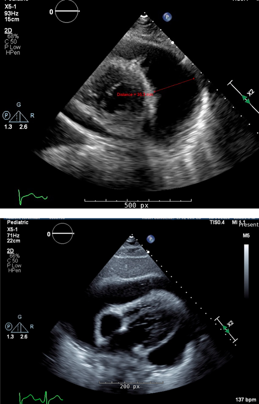 Pericardial Effusion Causing Cardiac Tamponade in a 10-Year-Old Male ...
