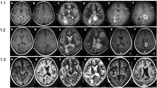 Primary Hemophagocytic Lymphohistiocytosis With Prolonged Primary ...