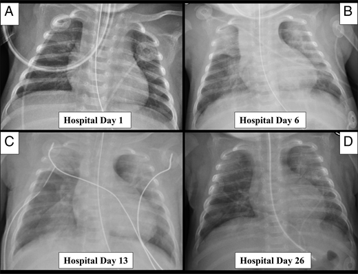 Safety of Tocilizumab and Remdesivir in Treating COVID-19 Pneumonia in ...