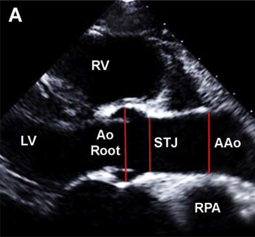 Health Supervision for Children and Adolescents With Marfan Syndrome ...