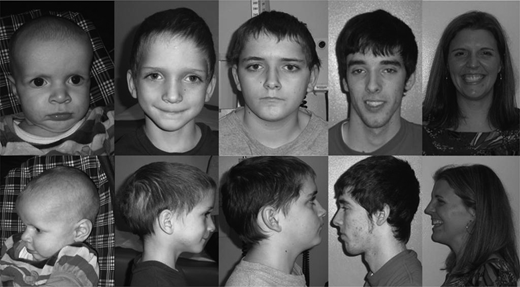 Health Supervision for Children and Adolescents With Marfan Syndrome ...