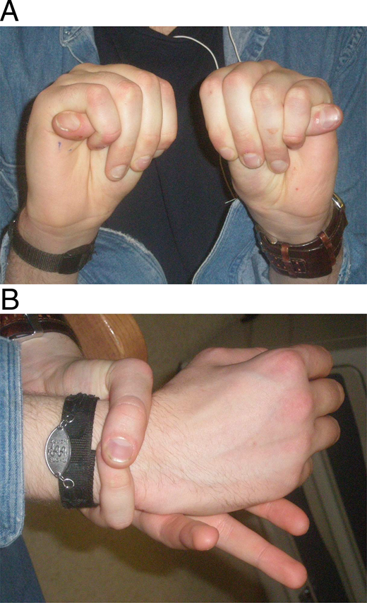 Health Supervision for Children and Adolescents With Marfan Syndrome ...