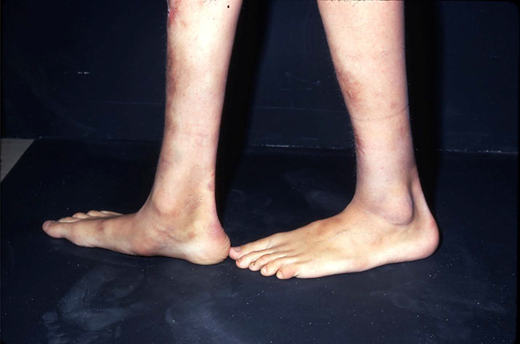 Health Supervision for Children and Adolescents With Marfan Syndrome ...