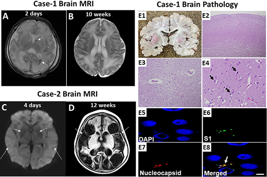 Maternal SARS-CoV-2, Placental Changes and Brain Injury in 2 Neonates ...