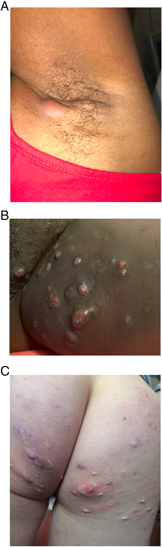 Hidradenitis Suppurativa in Pediatric Patients | Pediatrics | American ...