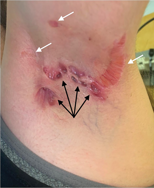 Hidradenitis Suppurativa in Pediatric Patients | Pediatrics | American ...