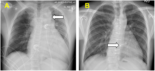 Aortic Dissection in a Young Patient With Unsuspected Aortopathy ...