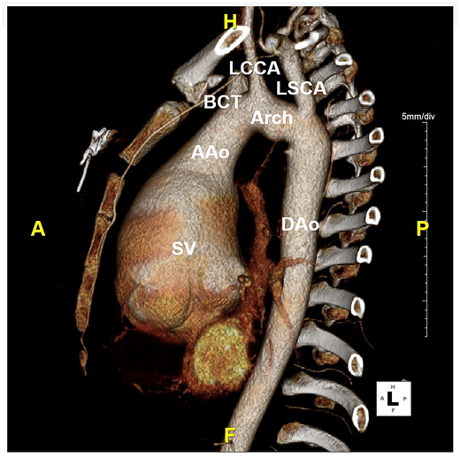 Aortic Dissection in a Young Patient With Unsuspected Aortopathy ...