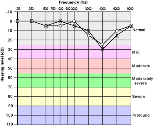 Preventing Excessive Noise Exposure in Infants, Children, and ...