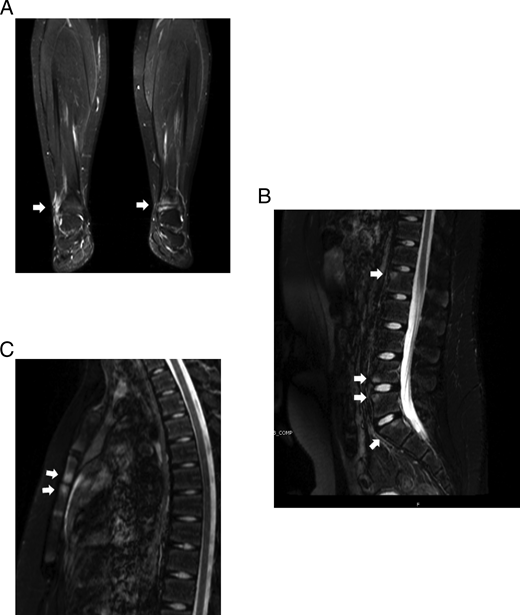 Chronic Recurrent Multifocal Osteomyelitis Involving the Spine, Sternum ...