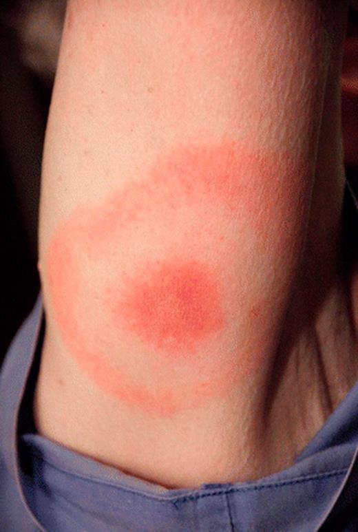 Borrelia burgdorferi (Lyme Disease) | Pediatrics In Review | American ...